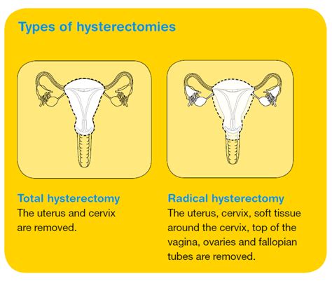 Hysterectomy Treatment Of Hysterectomy Types Diseases Hot Sex Picture