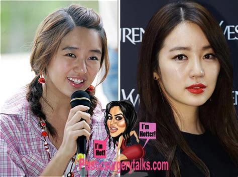 Yoon Eun Hye Plastic Surgery Before And After