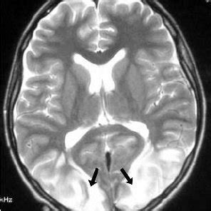 Active Diffuse Anterior Scleritis In The Temporal Quadrant Of The Left Download Scientific