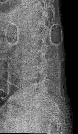 Compression Fracture X Ray