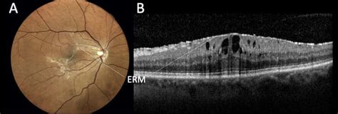 Macular Pucker Care Retina Consultants San Diego