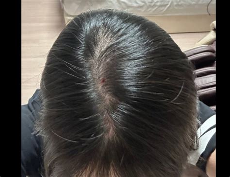 여자 정수리 탈모 지식in