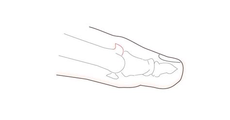 Minimally Invasive Cheilectomy Surgery At London Foot And Ankle Surgery