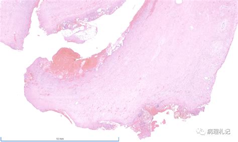 病理视角 一名65岁女性胆囊增厚在胆囊浆膜上发现病变 医学界 助力医生临床决策和职业成长