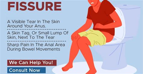 Understanding Fissures Symptoms Development And Examination At Vithai Piles Hospital