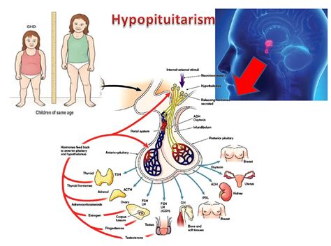 Hypopituitarism Girl