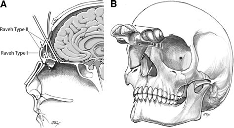 A Panoramic Approach To The Anterior Skull Base—the Combined Subfrontal
