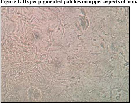 Figure 2 From Pityriasis Versicolor Tinea Versicolor Due To