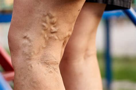 Spider Veins Causes And Treatments Milner Vein And Vascular