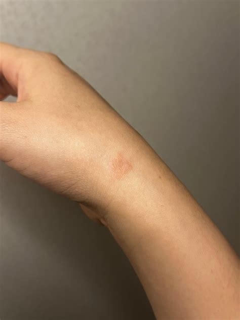손등에 빨간 반점이 났는데 뭘까요 가려움 통증x 지식in