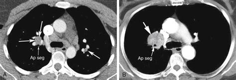 The Pulmonary Hila Radiology Key