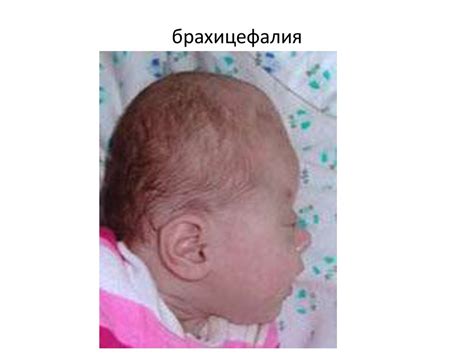 Аномалии черепа - презентация онлайн