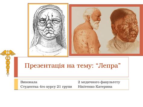 Презентація на тему Лепра Презентации Инфекционные болезни Docsity