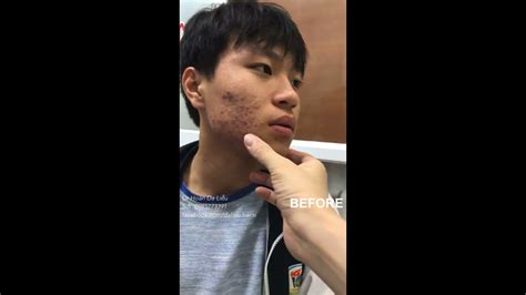 Dermatologist Treating Squeeze Pimples Whitehead Blackhead Pustule