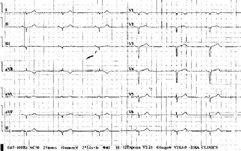The Initial Rest 12 Lead Ecg Of The Participant Showing Sinus Download Scientific Diagram