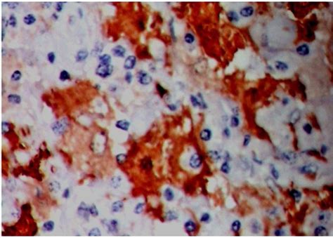 A And B Numerous Histiocytes Multinucleated Giant Cell With Extensive