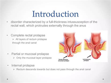 Rectal Prolapse D1 Pptx