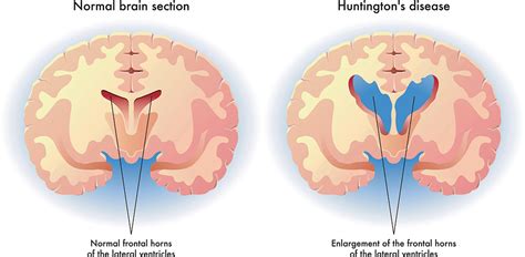 Lethal Mutation Definition And Examples Biology Online Dictionary