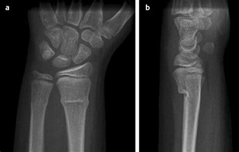 Impacted Fracture Wrist