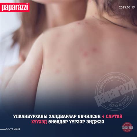 ХӨСҮТ Улаанбурханы халдвараар өвчилсөн 4 сартай хүүхэд өнөөдөр үүрээр