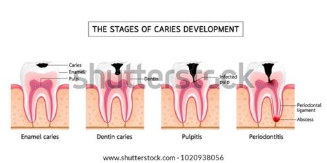 Stages Caries Development Enamel Caries Dentin Stock Vector Royalty