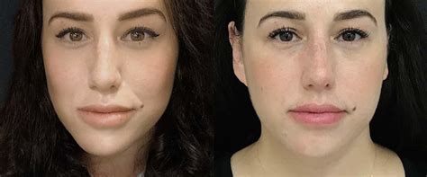 The Benefits Of Cheek Fillers A Guide To Enhancing Your Facial Features
