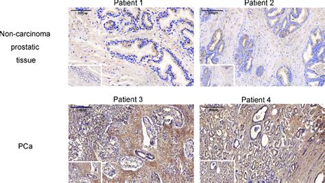 The Oxytocin Expression In No Carcinoma Prostate Tissue And The Pca Download Scientific Diagram