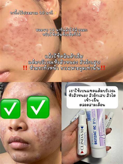 สิวหายใน 3 เดือน ด้วย Benzac และ Clinda M 👍🏻 แกลเลอรีที่โพสต์โดย พอย