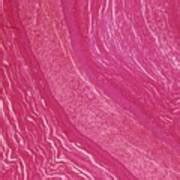 Dermoid Ovarian Cyst Photograph By Cnri Science Photo Library Fine Art America