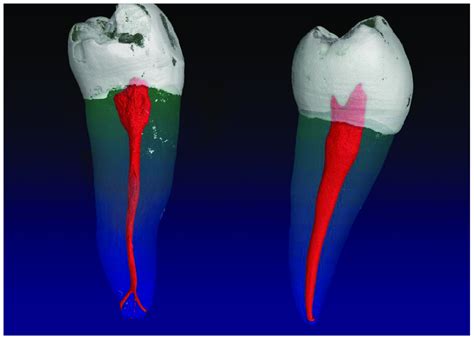 Mandibular Second Premolars With A 1 1 1 2 RCC Left And An Accessory