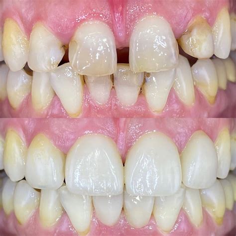 Laser Frenulectomy Vega