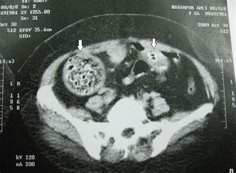 Contrast Enhanced Abdominal Computed Tomography Transverse Image