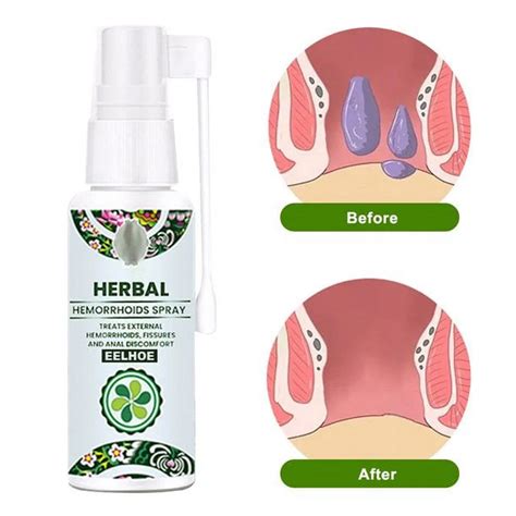 Jual Obat Ambeien Paling Ampuh Eelhoe Herbal Spray Wasir Ambeyen