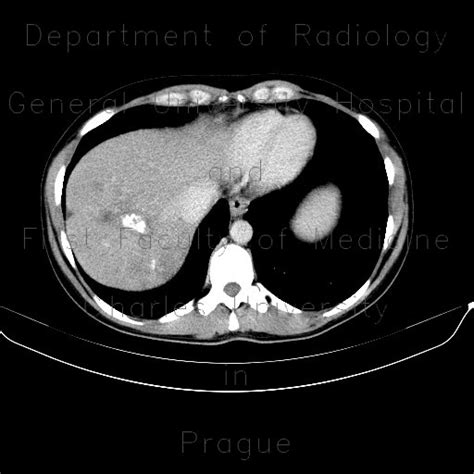 Radiology Case Calcification Of Metastases In Liver From The Ovarian Cancer With Regressive