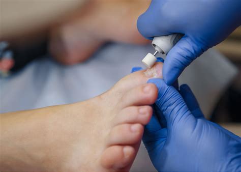 Chiropody Clinic Chiropodists And Podiatrists Somerset