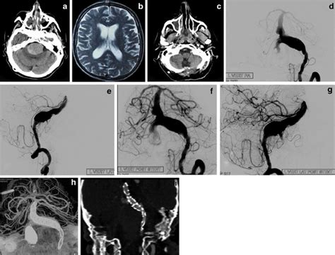 A Axial Ct Image Showing Basilar Artery Fusiform Aneurysm Causing