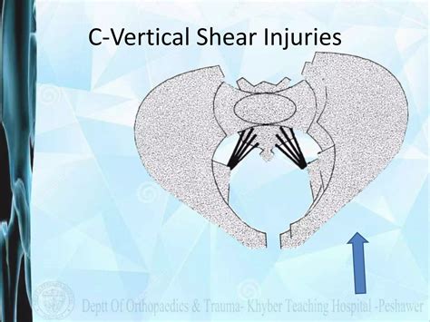 Pelvic Fracture Classification Pptx