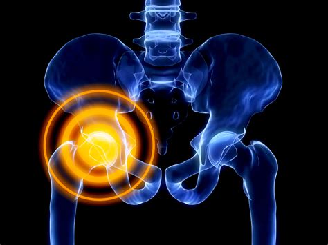 Subspine Impingement Hip Specialist Sugar Land Pearland Houston Tx