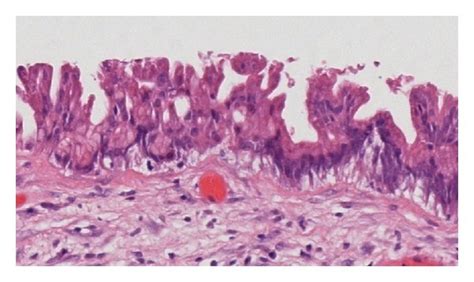 A And B Ipmn Gastric Foveolar Branch Duct Subtype With Low Grade