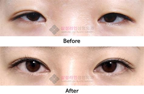 여름 맞이해 회복 빠른 ‘자연유착법 쌍꺼풀 성형 인기 Bnt뉴스