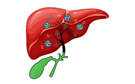 What Is Primary Biliary Cholangitis MedEvidence