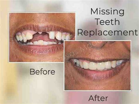 What Is The Cheapest Way To Replace A Missing Tooth Dental News Network