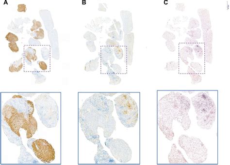Clinical Relevance Of The In Situ Assay For Hbv Dna A Cross Sectional