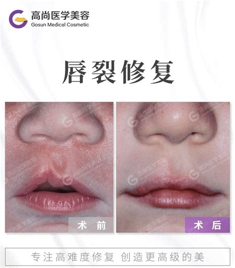 哪家医院做唇裂修复整形手术好 哔哩哔哩