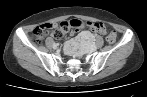 A Contrast Enhanced Computed Tomography Lobulated Well Enhancing