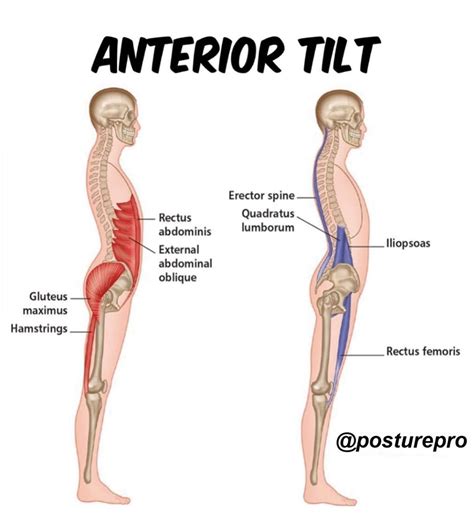 Fix Anterior Pelvic Tilt Dicas De Treino Avaliação Postural