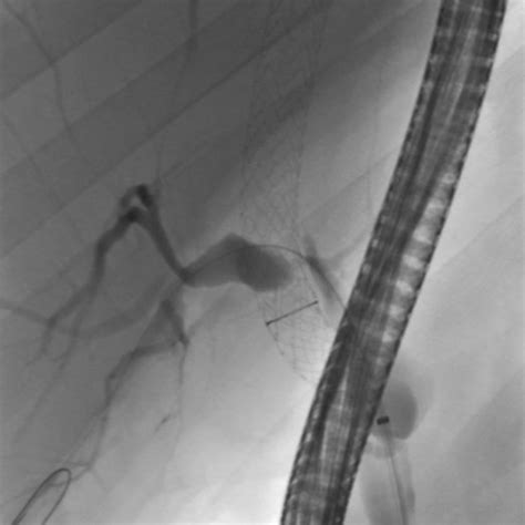Mrcp Demonstrating Mild Intrahepatic Ductal Dilatation Download
