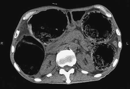 Figure1 Preoperative CT Findings In The CI Group The CT Revealed A Download Scientific Diagram