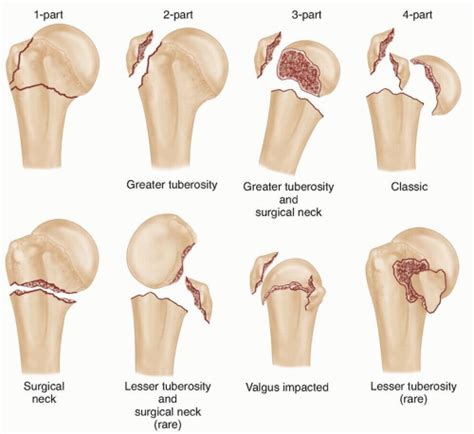 Proximal Humerus Fracture Presentation