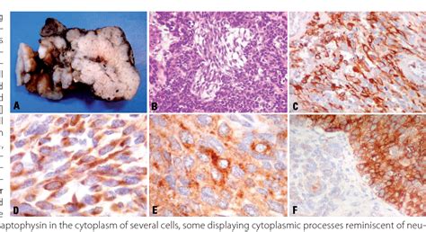 Figure 2 From Supratentorial Primitive Neuroectodermal Tumor Pnet An Uncommon Location